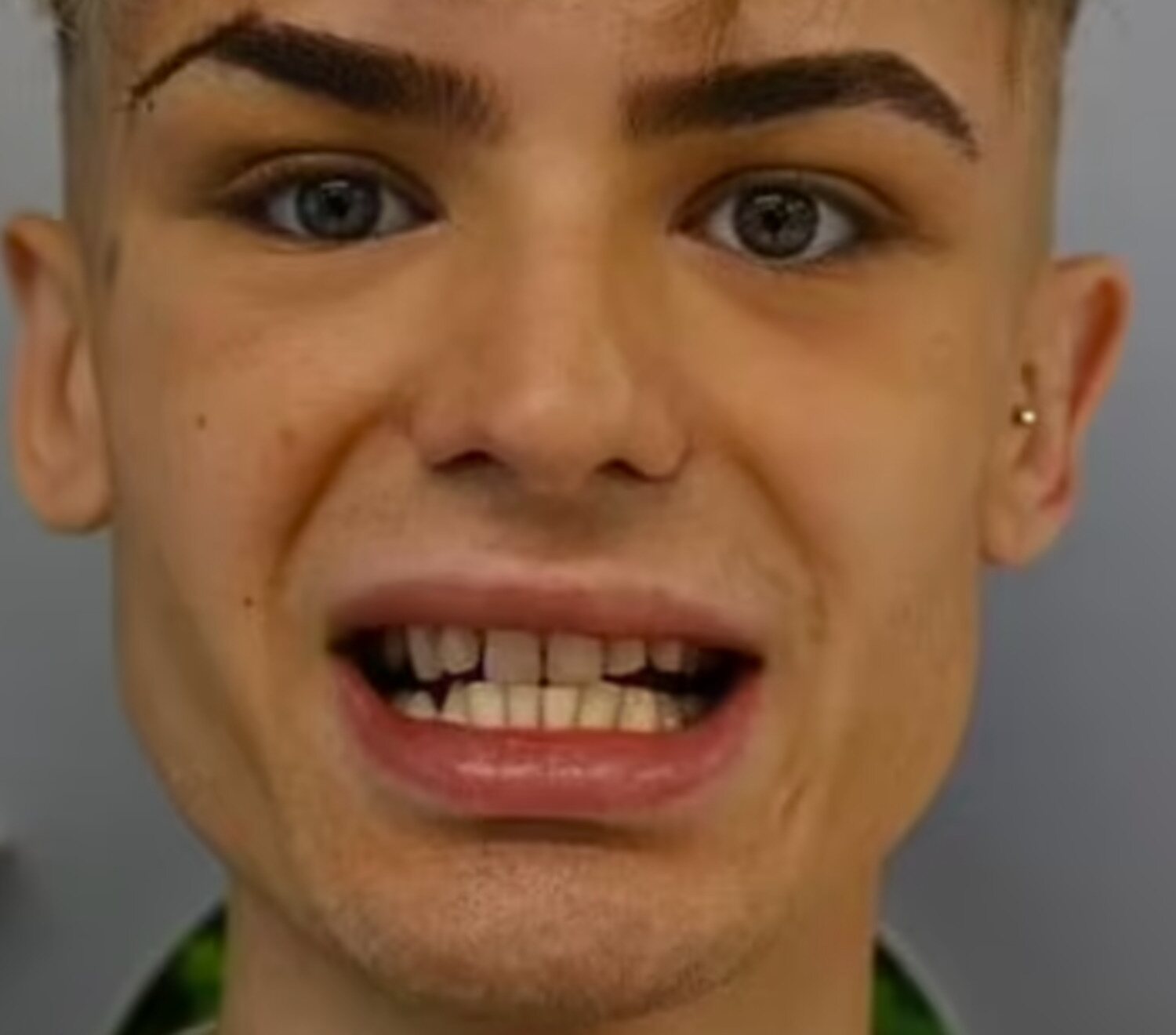 Un modelo se gasta miles de euros en una operación de dientes y se ...