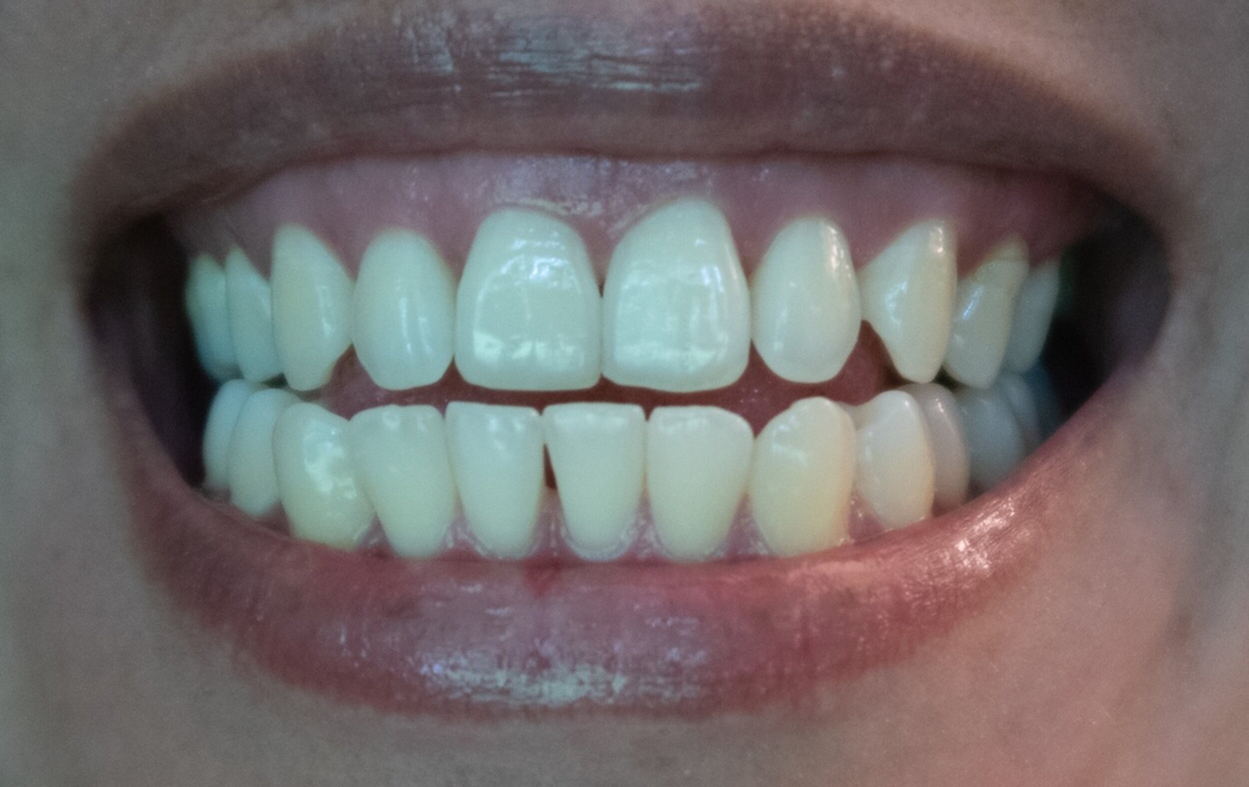 Impulsan un fármaco que regenera los dientes caídos